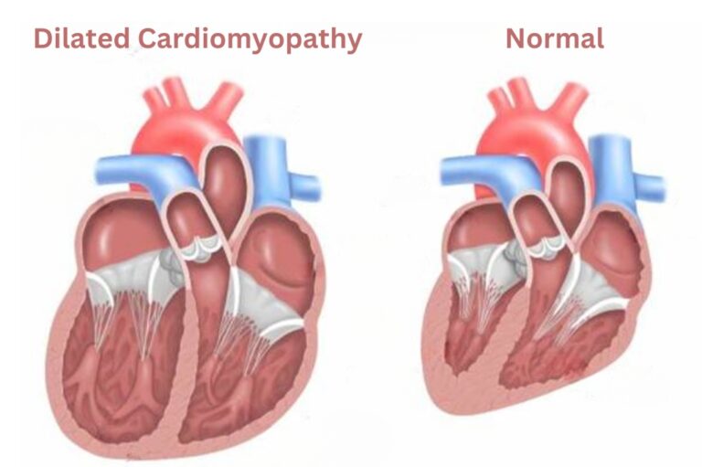 Life Expectancy of a Dog with Dilated Cardiomyopathy: Prognosis Factors ...